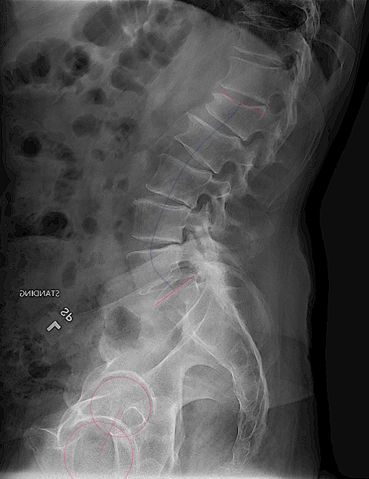Medtronic Cranial & Spinal Technologies | Featured Cases | Daniels