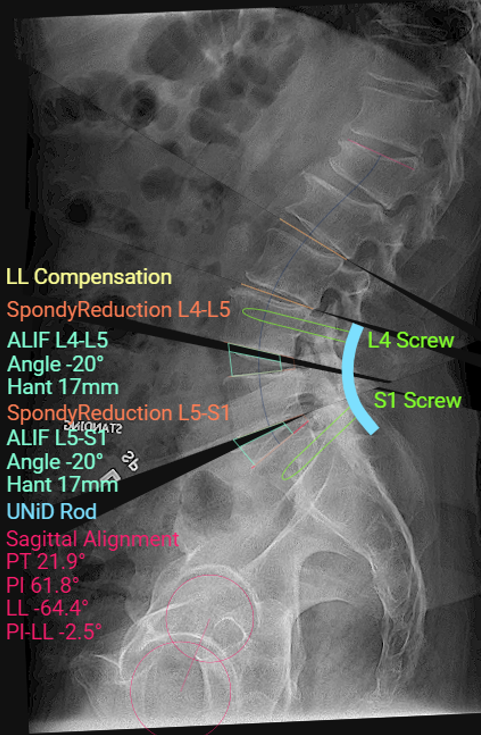 Medtronic Cranial & Spinal Technologies | Featured Cases | Daniels