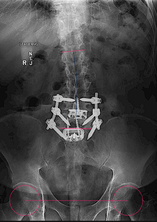 Medtronic Cranial & Spinal Technologies | Featured Cases | Daniels